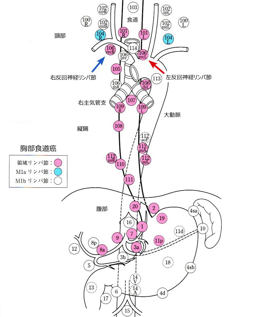 食道がん術後はつらいね – 手術